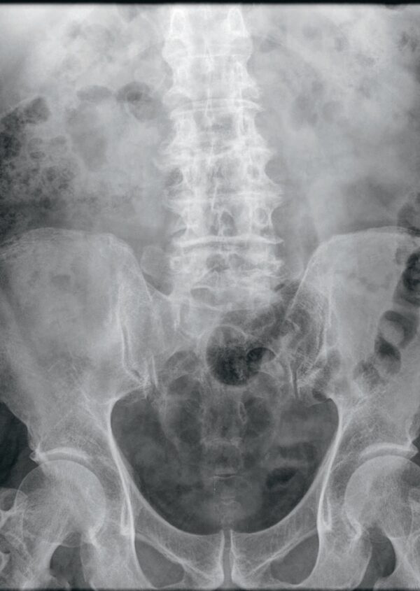 L'abdomen sans préparation - Rebelle-Santé